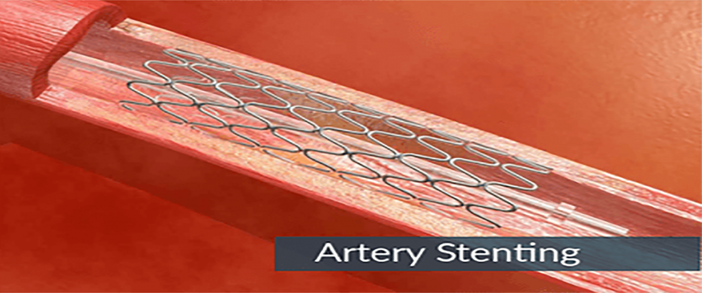 Benefits of Endovascular Repair with a Stent Graft | Dr.Abhilash