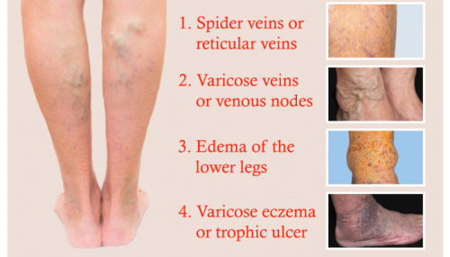 What are The Stages of Varicose Veins Disease? | Dr Abhilash