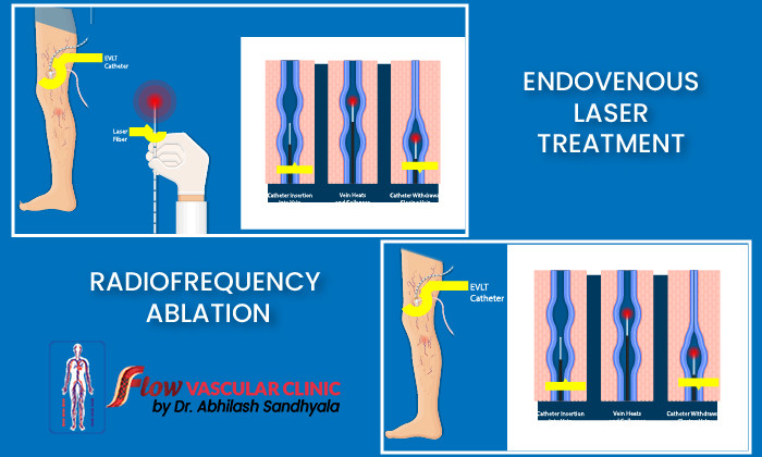 Endovenous Laser Ablation versus Radiofrequency Ablation -Dr.Abhilash ...